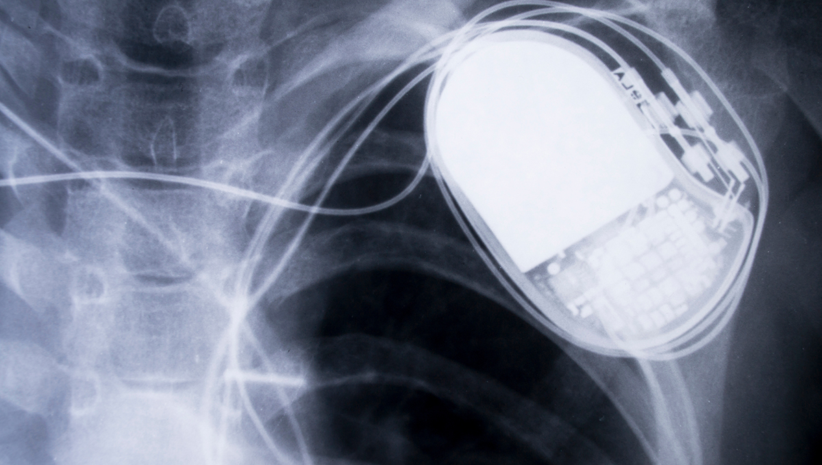 More HF, Worse Long-term Outcomes in TAVI Patients Who Get Pacemakers | tctmd.com